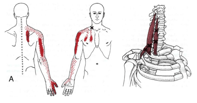 Weightlifting and Trigger Points: Scalenes