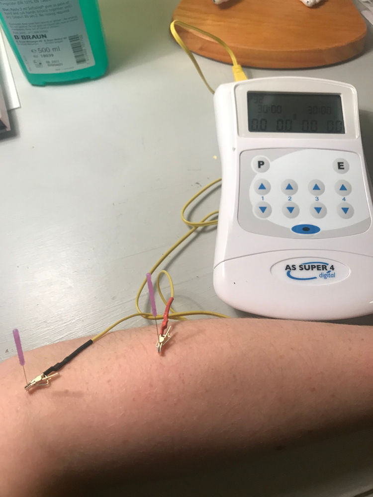 What are the Benefits of Electroacupuncture?