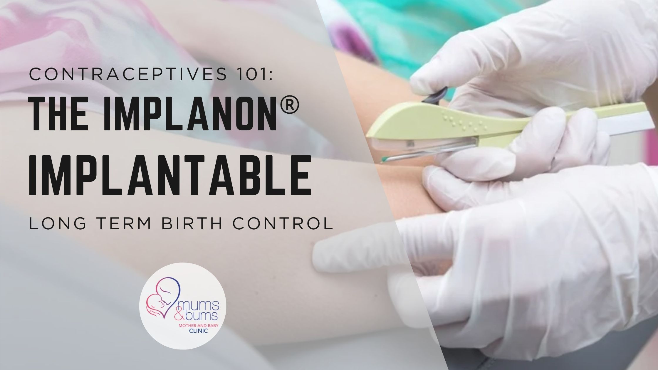 Implanon® Implant in South Africa | 3-Year Birth Control Guide