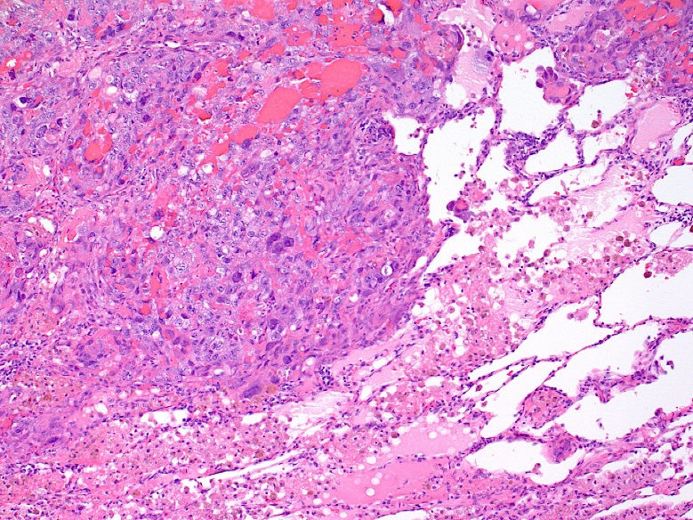 Large Cell Carcinoma of the Lung