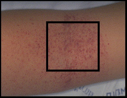 Dengue Epidemic in Puerto Rico 2024