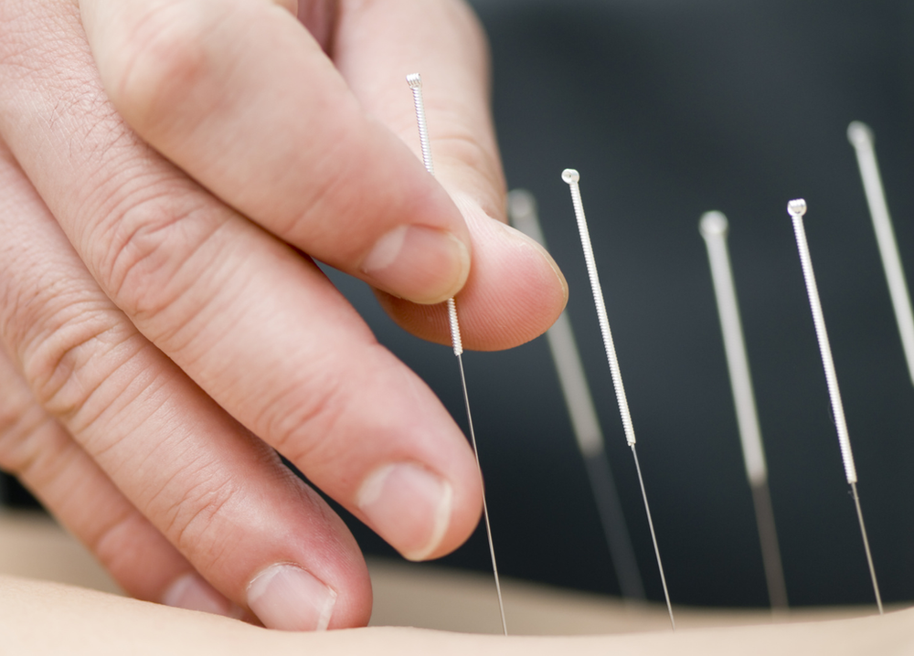 Dry Needling Vs Acupuncture: Aren’t they the same?