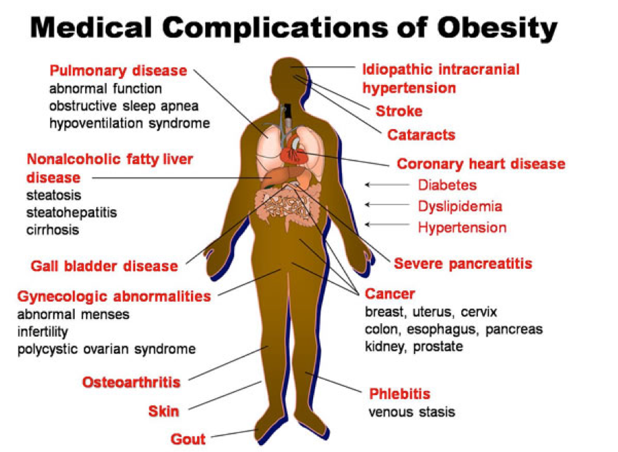 Obesity: Health Risk