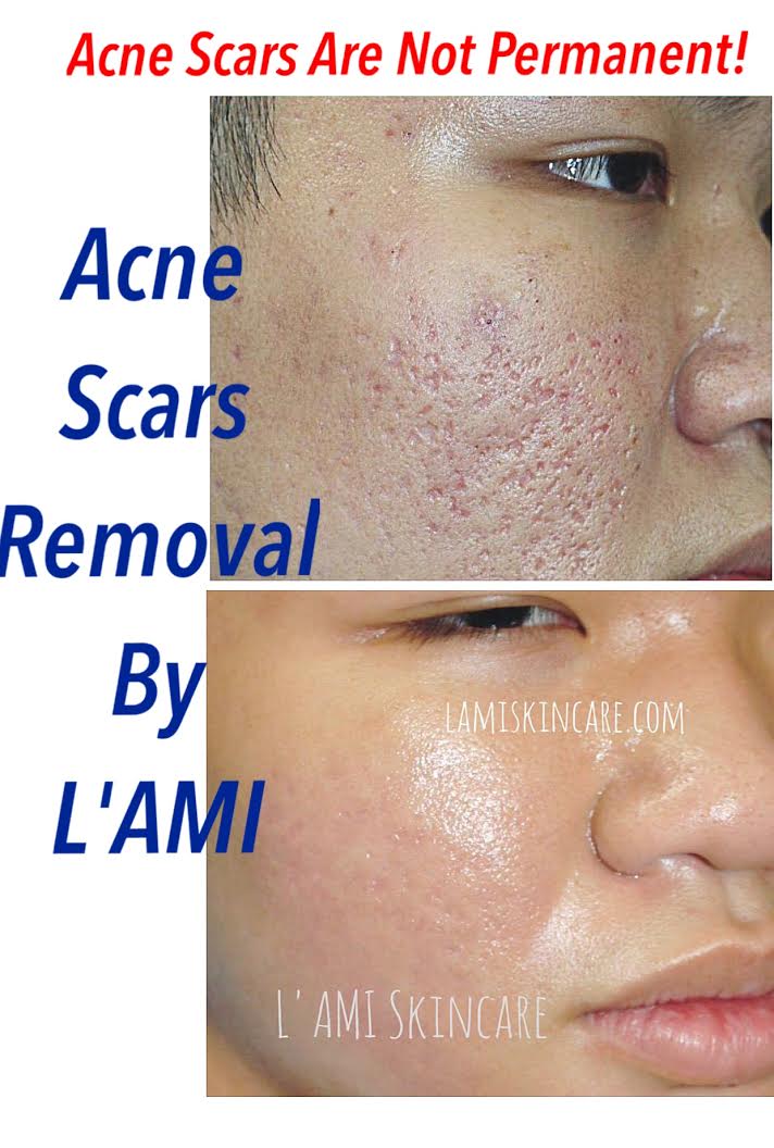 Best Ance Scars Treatment in the Bay Area