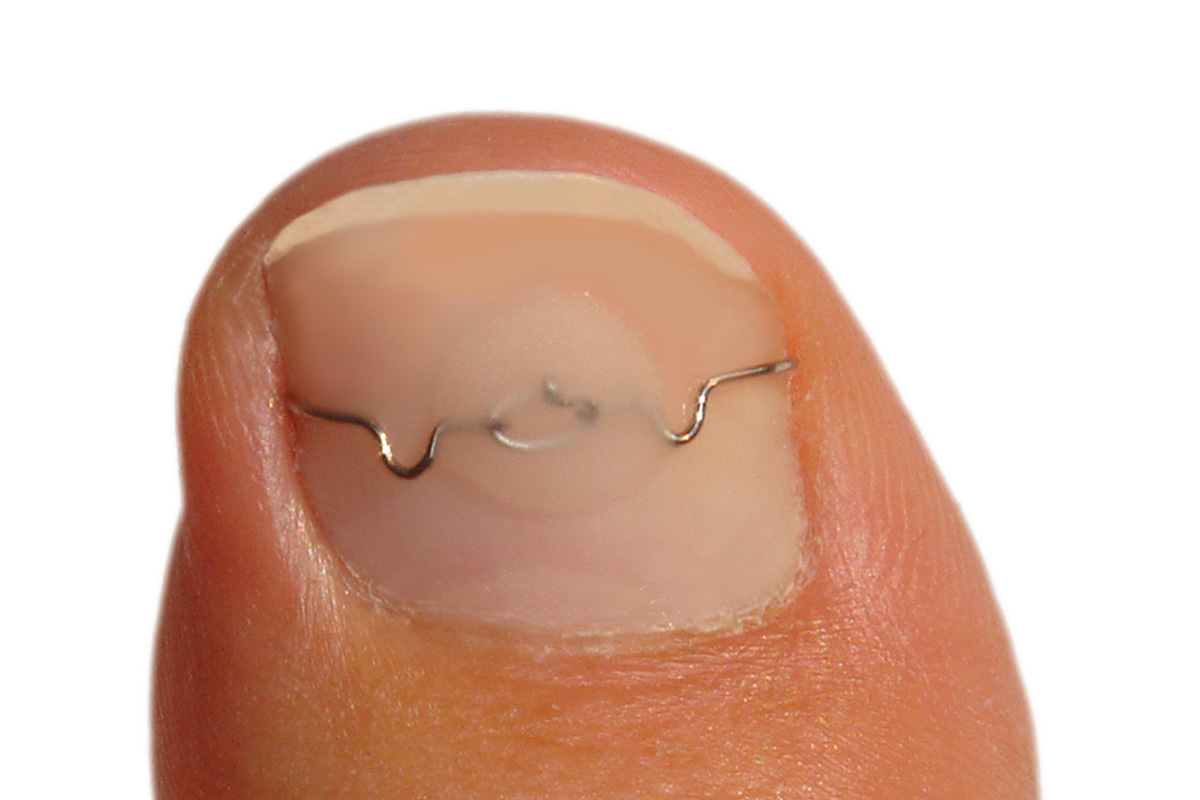 Inngrodd tånegl | Fot & Ankel Spesialisten | Minde allé 48