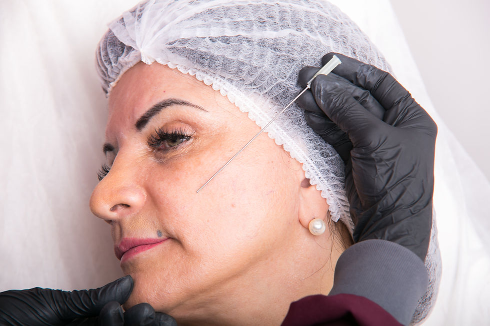 Como funciona a recuperação dos Fios de sustentação (PDO)