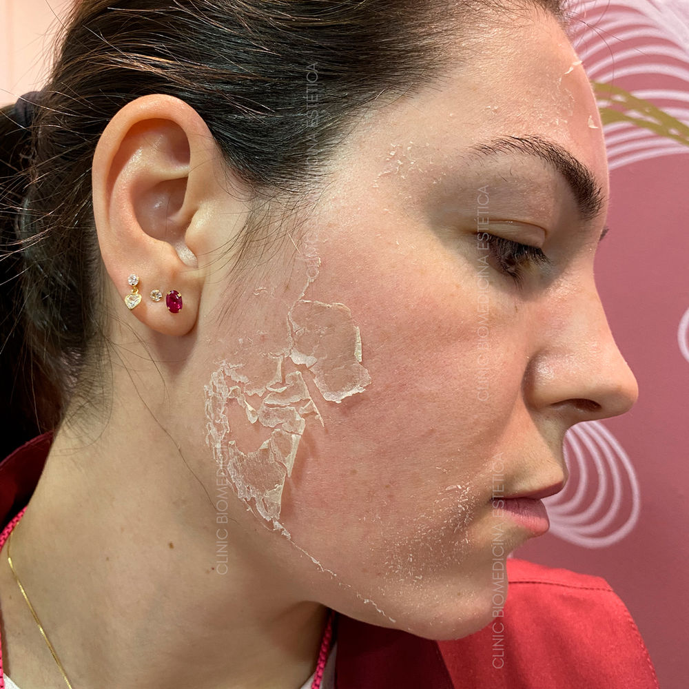 Peelings do Mar Morto, Químicos e Mecânicos. Saiba qual a melhor opção