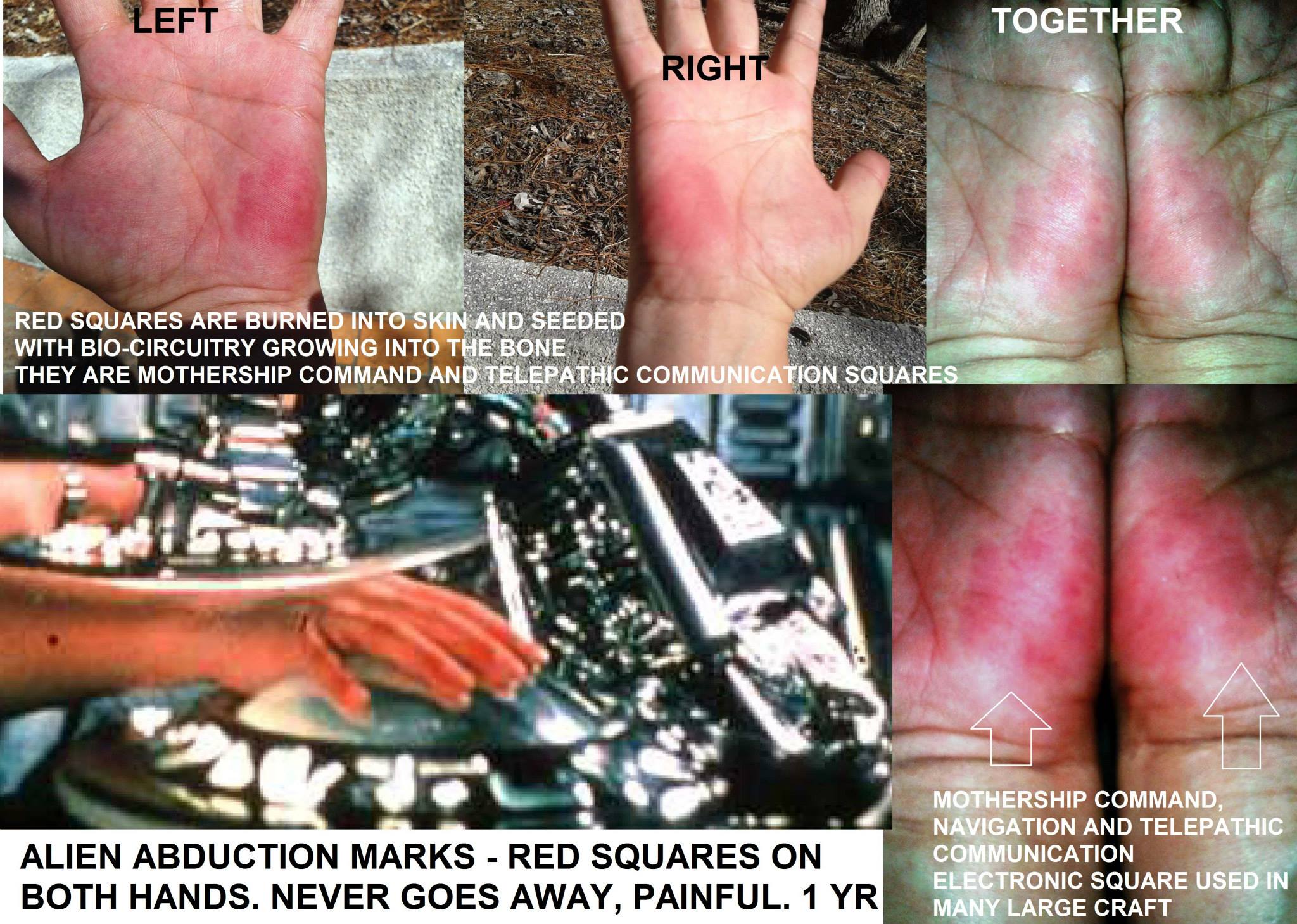 Alien Abduction Scratch Marks (AASM) | Super Soldier Talk