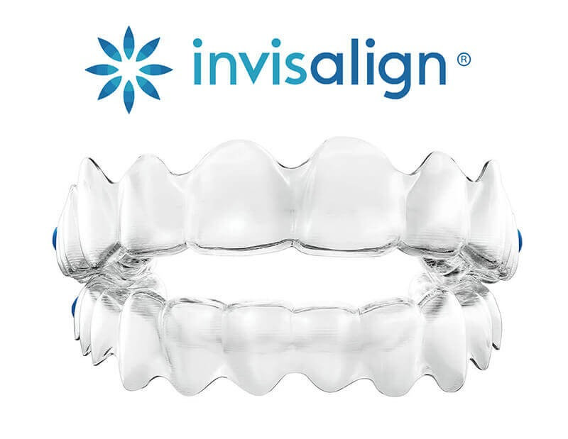 Invisalign progress journal 1 (month 1)