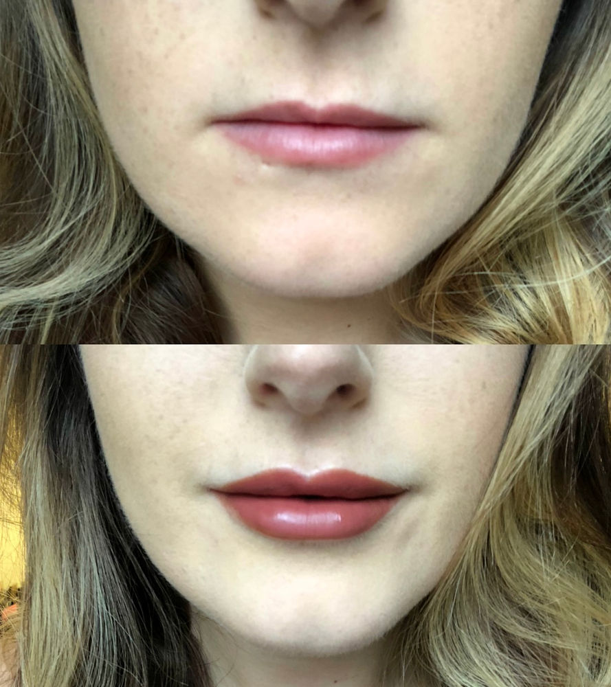 GETTING 1ML LIP FILLERS WITH FLAWLESS COSMETIC