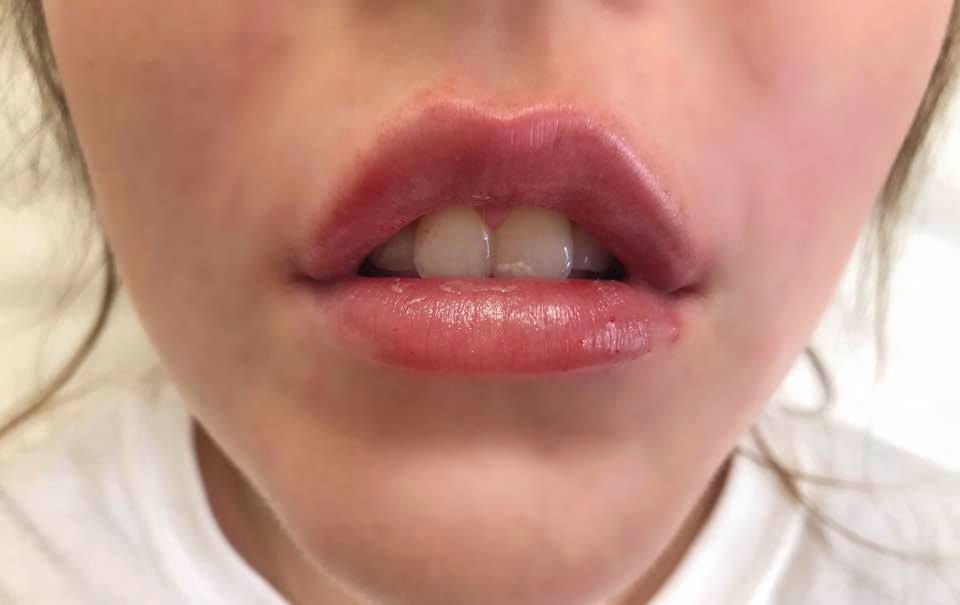 MY FIRST TIME GETTING LIP FILLERS WITH FLAWLESS COSMETIC my-first-time-getting-lip-fillers-with-flawless-cosmetic