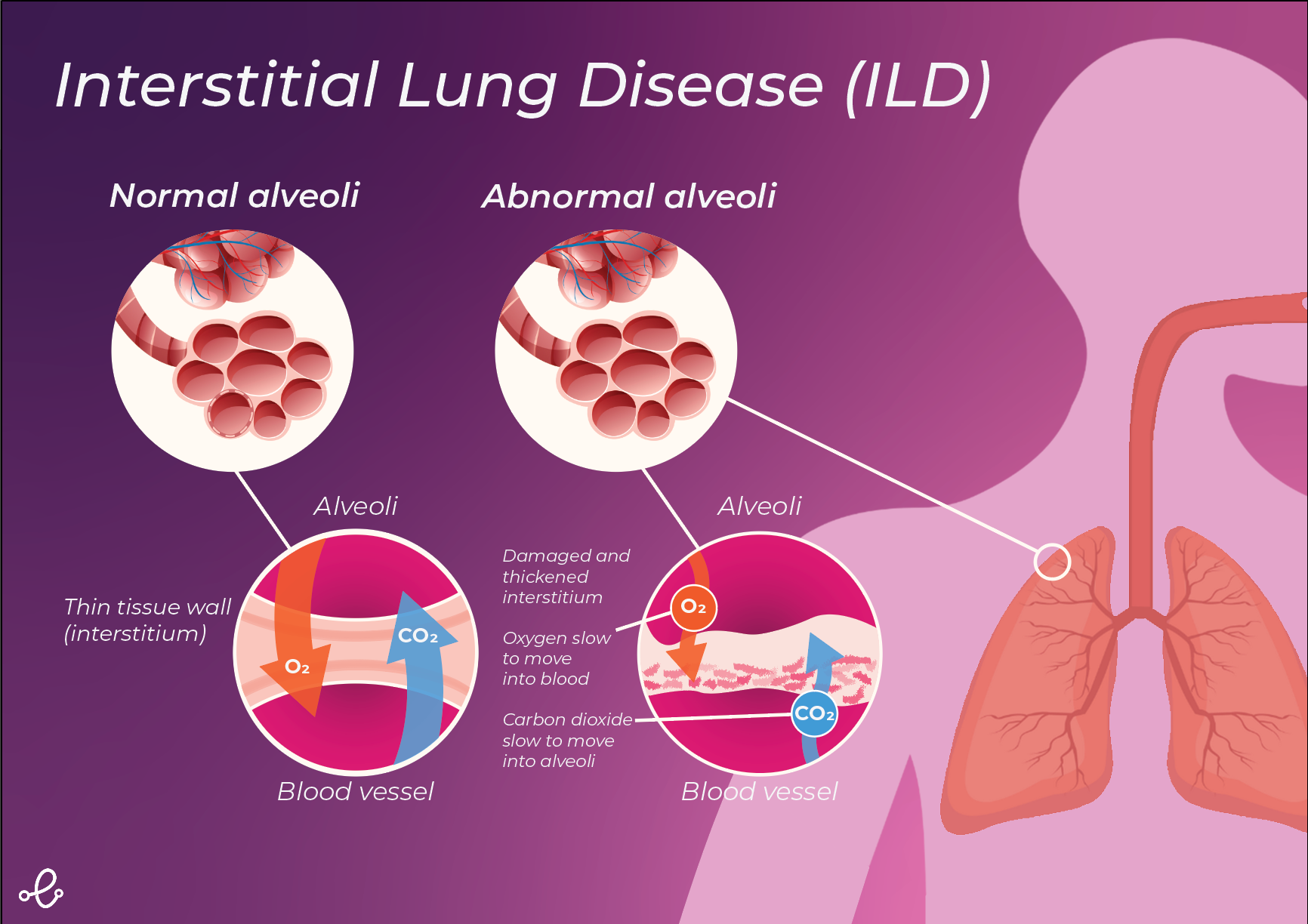 Understanding And Managing Interstitial Lung Disease ElectronRx