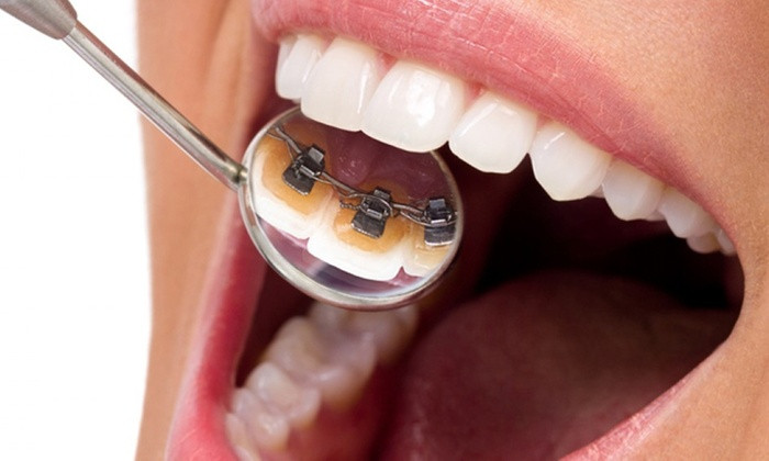 Lingual Braces Explained: Benefits and Drawbacks