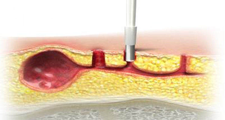 Pit-picking - o que é, vantagens e laser com plasma rico em plaquetas