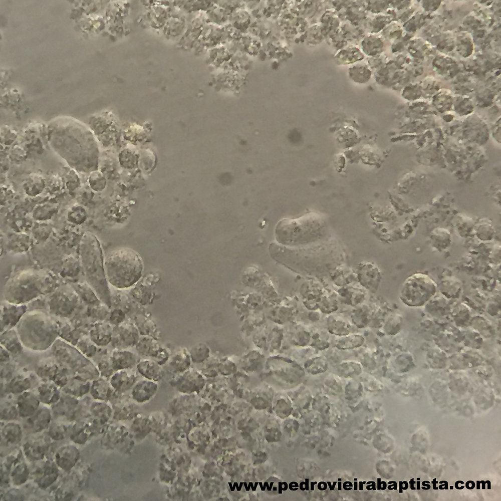 Vaginite aeróbica aumenta risco de ter uma citologia cervical alterada