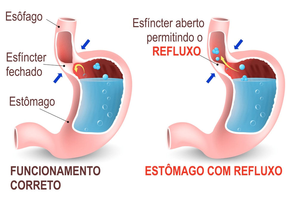 Doença do Refluxo.