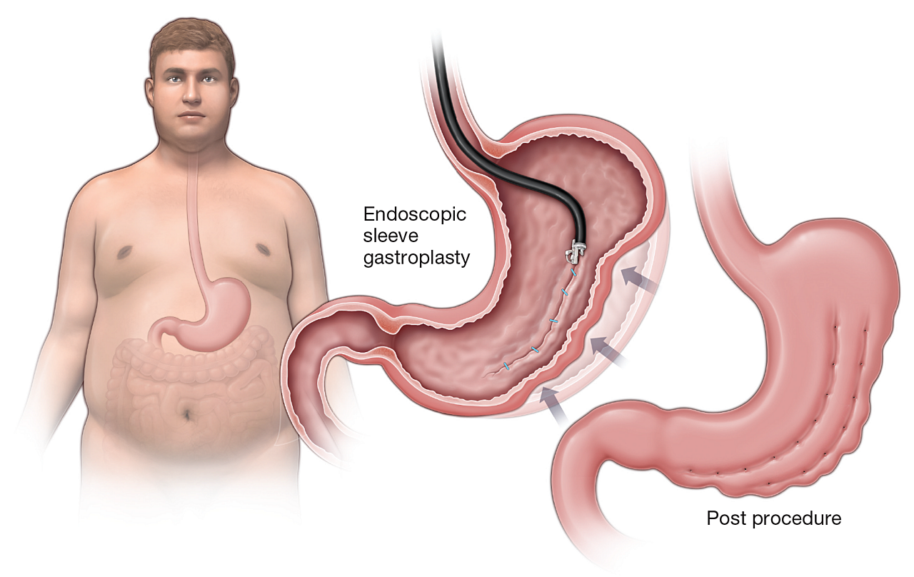 Apollo Endoscopic Sleeve Gastroplasty (ESG)