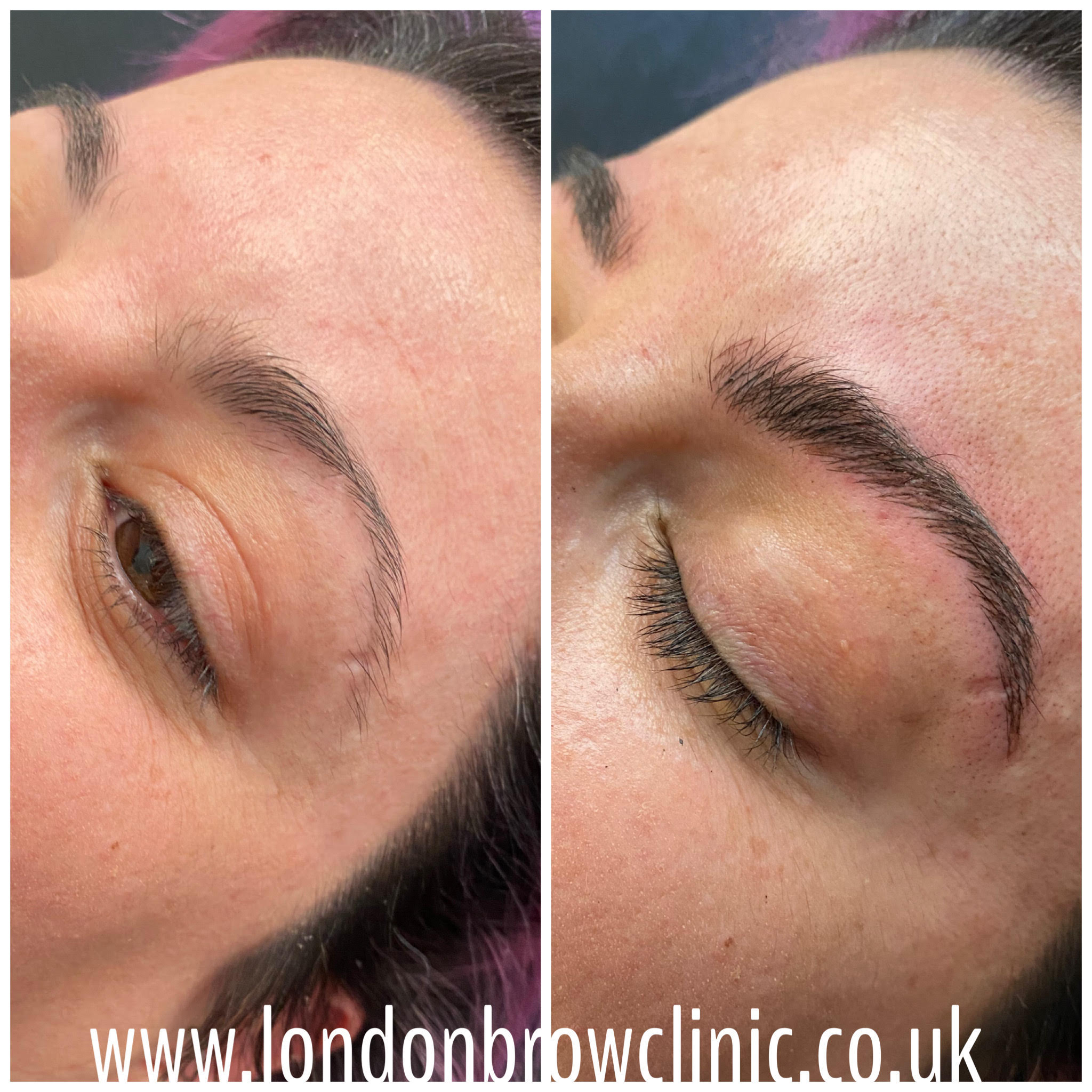 Microblading Specialist | London Brow Clinic | London
