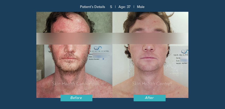 Red Skin Syndrome | Skin Health Centre