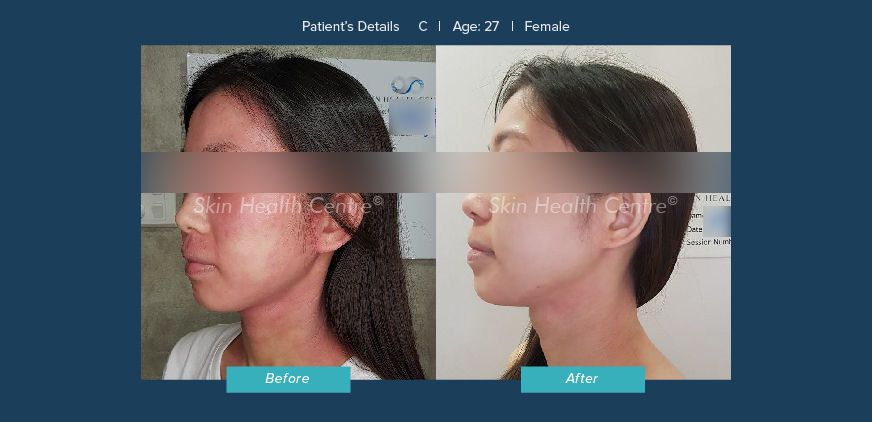 Red Skin Syndrome | Skin Health Centre