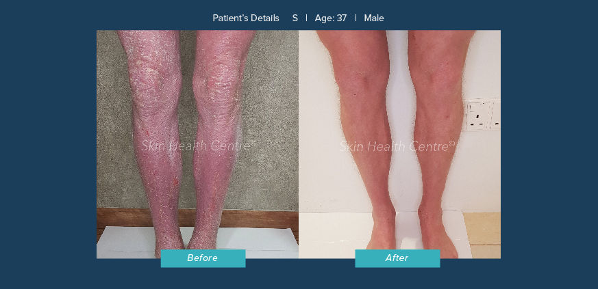 Red Skin Syndrome | Skin Health Centre