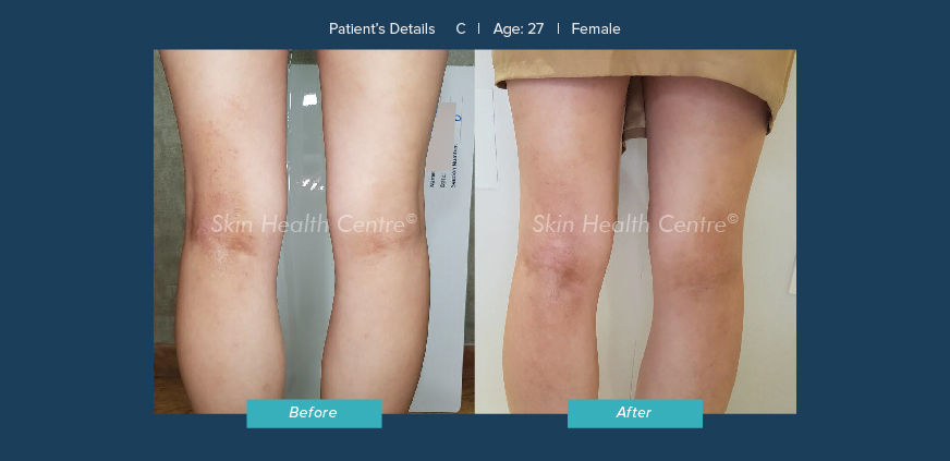 Red Skin Syndrome | Skin Health Centre