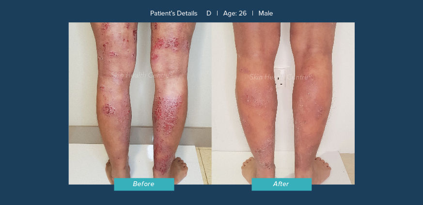 Red Skin Syndrome | Skin Health Centre