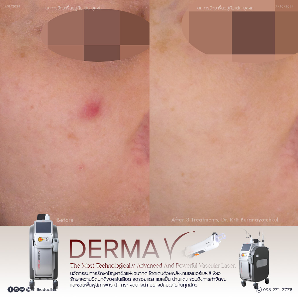 DERMA V LASER คืออะไร? เหมาะกับใคร? ทำที่ไหนดี?