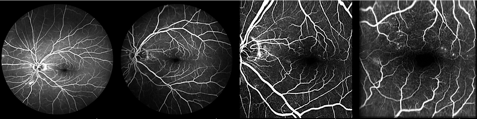 RETINOGRAFO FLUORANGIOGRAFO AUTOFLUORESCENZA ULTRAWIDE FIELD: SLO FA ...