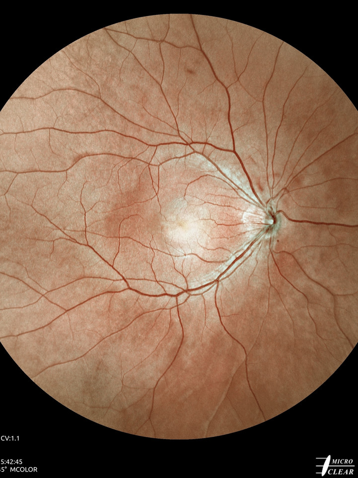 RETINOGRAFO FLUORANGIOGRAFO AUTOFLUORESCENZA ULTRAWIDE FIELD: SLO FA ...
