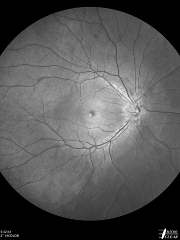 RETINOGRAFO FLUORANGIOGRAFO AUTOFLUORESCENZA ULTRAWIDE FIELD: SLO FA ...