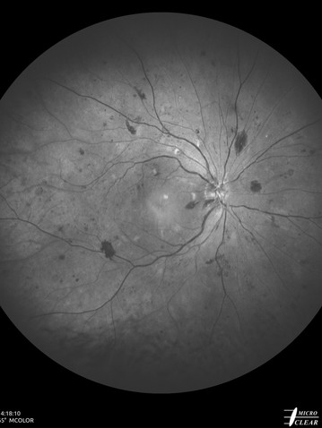RETINOGRAFO FLUORANGIOGRAFO AUTOFLUORESCENZA ULTRAWIDE FIELD: SLO FA ...