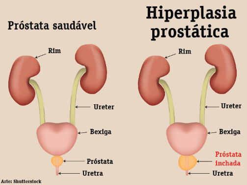 Hiperplasia Prostática Benigna (HPB)