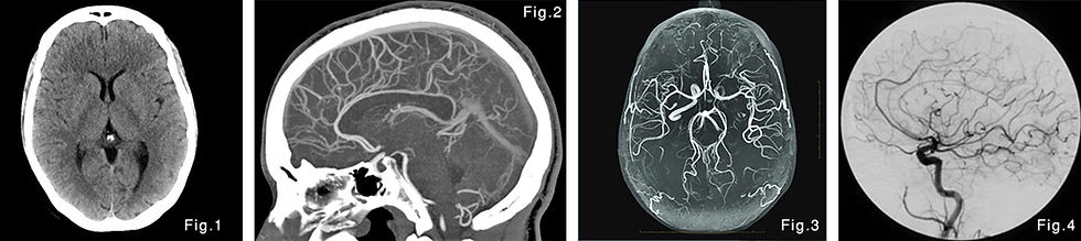 Understanding Brain Aneurysms: Causes, Symptoms, and Treatment Options Understanding Brain Aneurysms: Causes, Symptoms, and Treatment Options