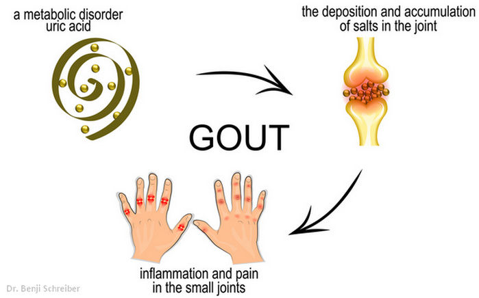 How to Get Rid of Gout Pain Fast? - Gout Treatment Types