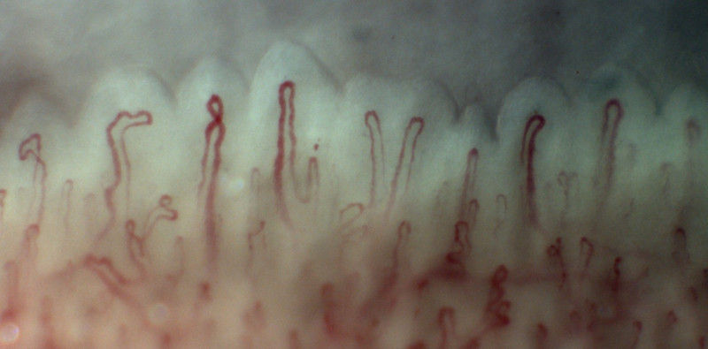 Undifferentiated Systemic Rheumatic Disease (UCTD) | Dr. Benji Schreiber