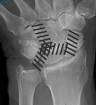 Total Wrist Replacement | Oceanside Ortho