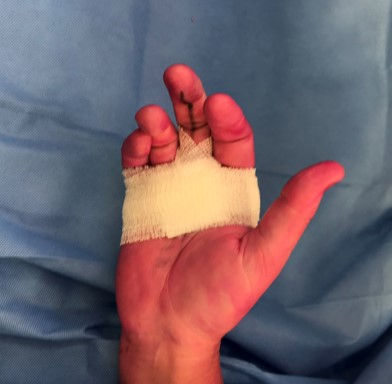 Trigger Finger | Oceanside Ortho