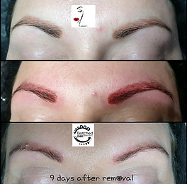 BOTCHED INK REMOVAL | Mysite