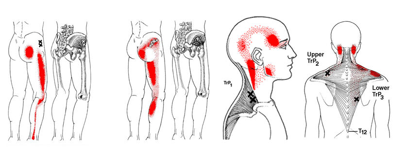 What is Trigger Point Therapy?