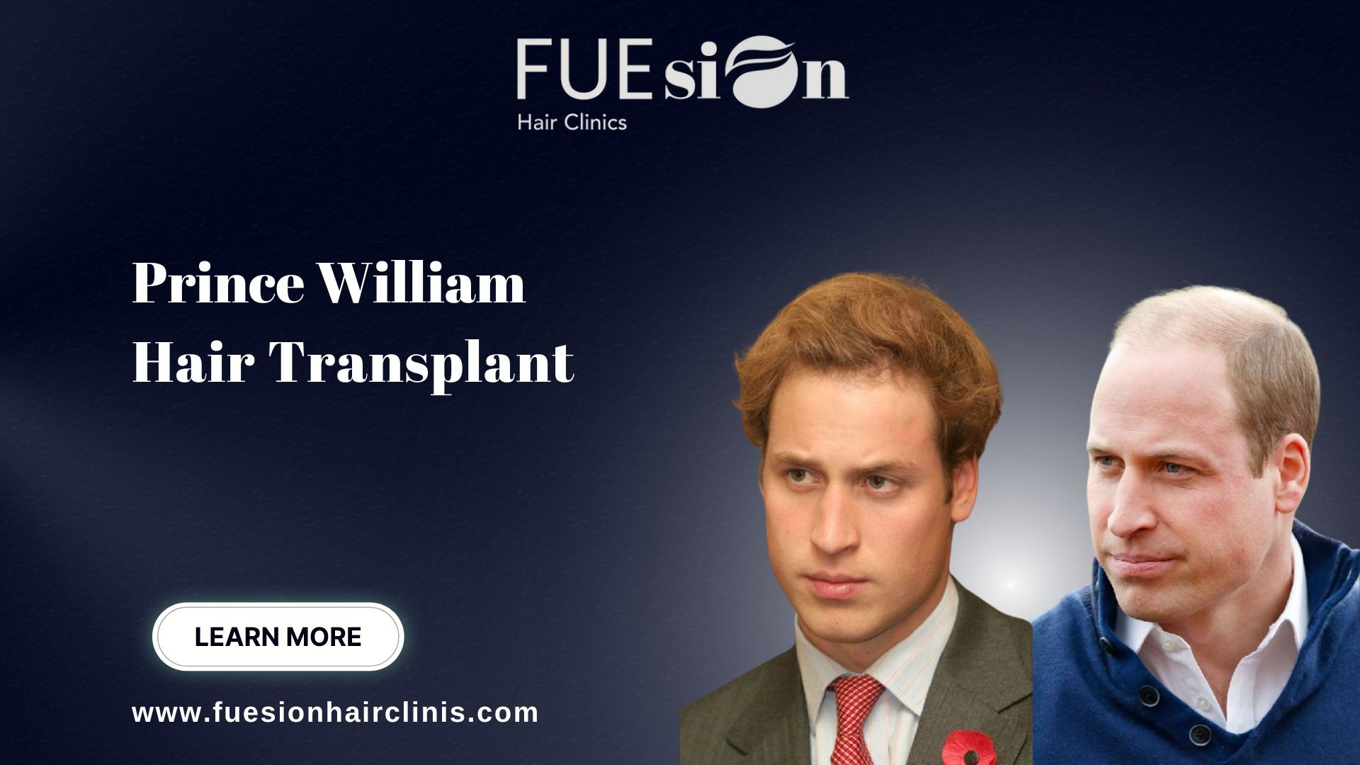 Prince William Hair Transplant: A Look at FUEsion Hair Clinics