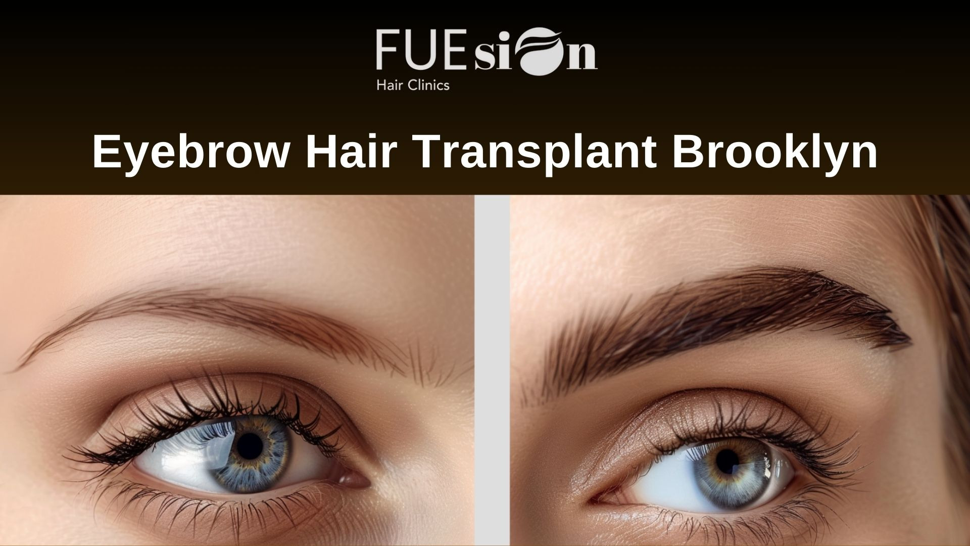 Eyebrow Hair Transplant Brooklyn: FUEsion Hair Clinics Leads the Way