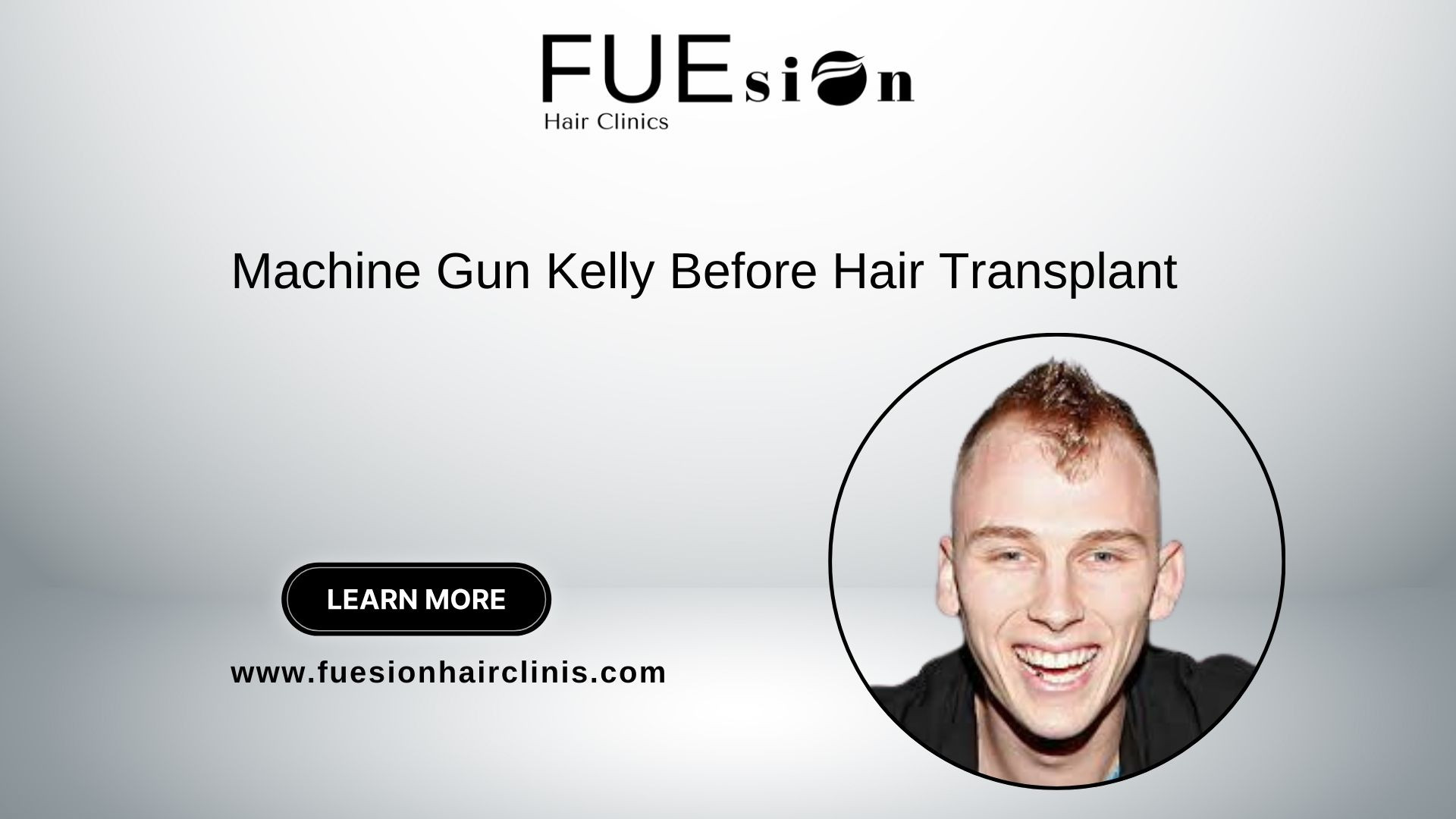 Machine Gun Kelly Before Hair Transplant: The Transformation and Why ...