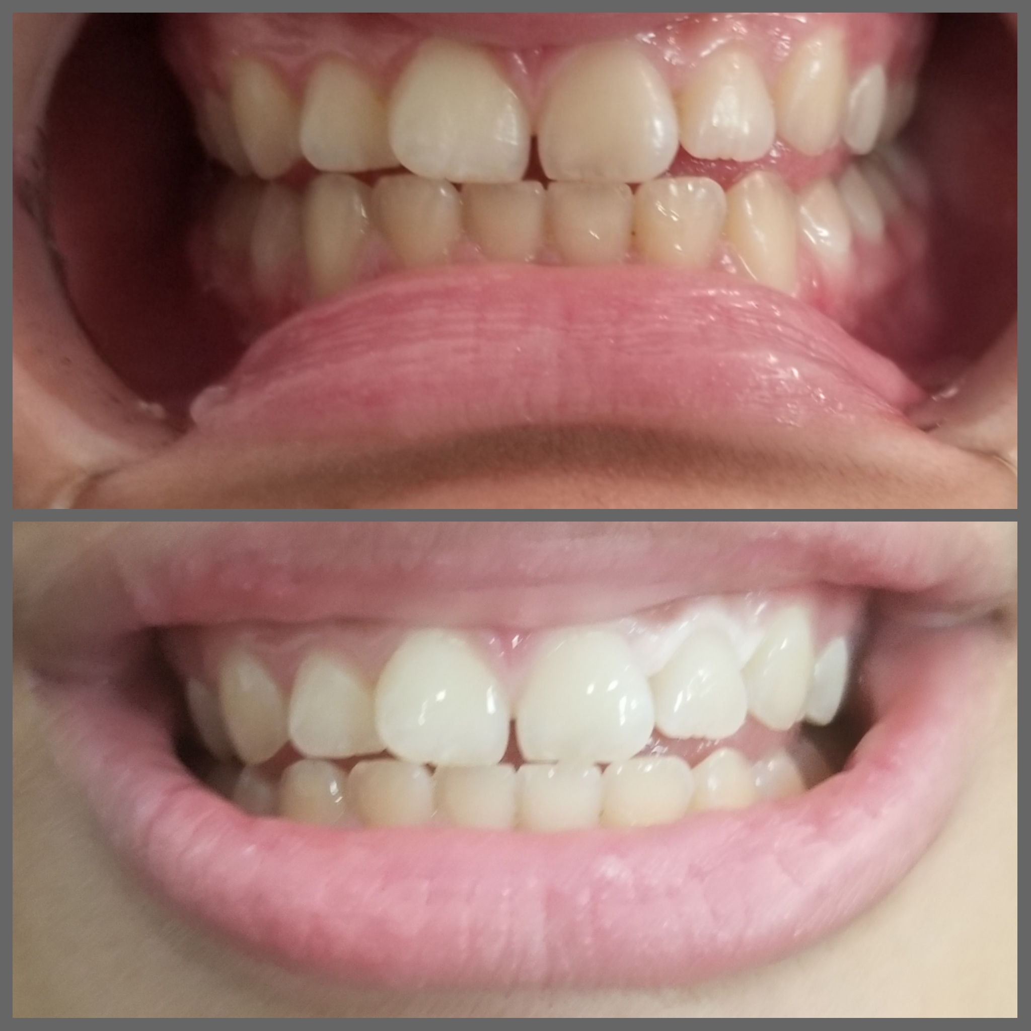 Gallery | Slim Fit Beauty | Body Contouring in Houston and Humble, Tx