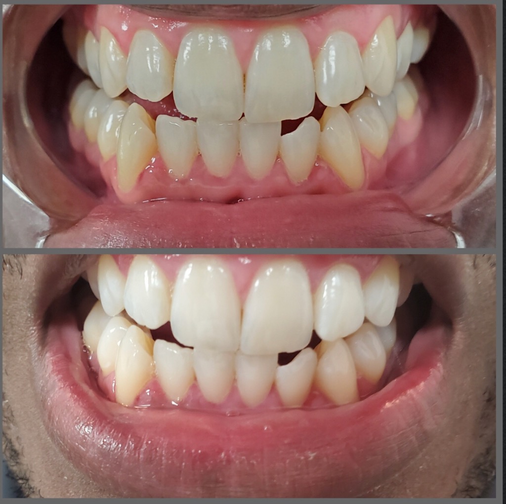 Gallery | Slim Fit Beauty | Body Contouring in Houston and Humble, Tx