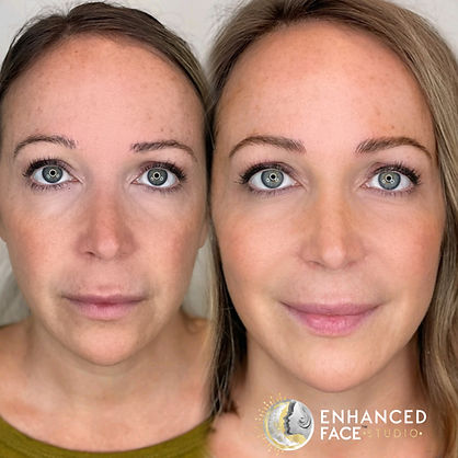 Before and After Gallery | Enhanced Face Studio