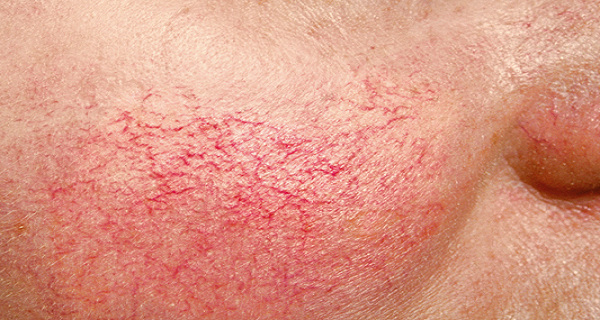 Broken Capillary Treatment | Morris Code Beauty