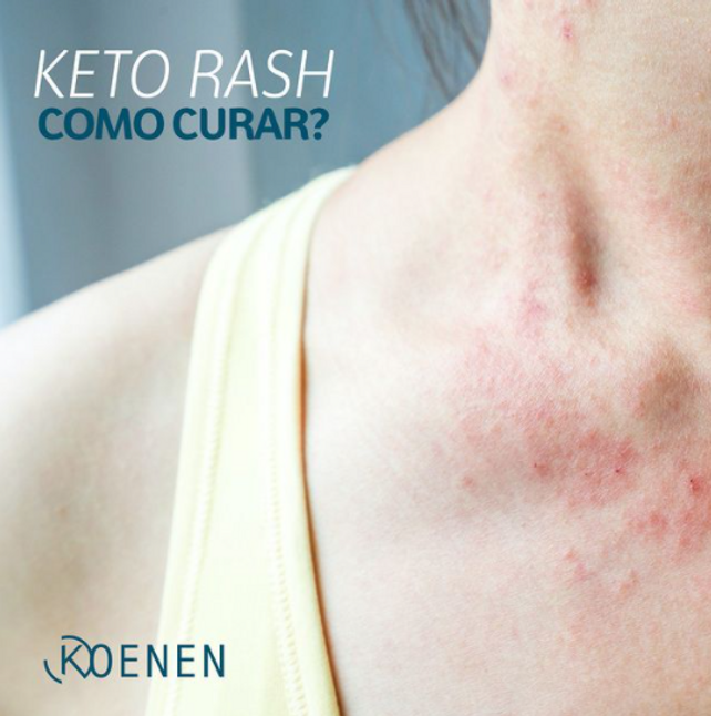 Keto Rash: como curar