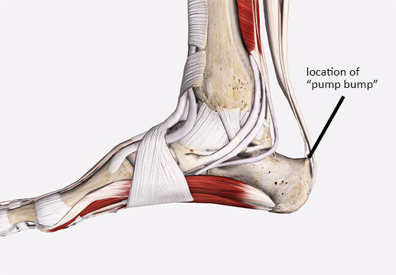 WHAT’S A PUMP BUMP?