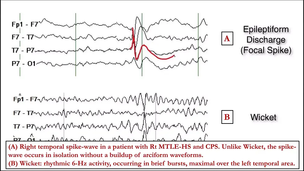 Deciphering Brain Waves: Understanding Wicket Spikes in EEG